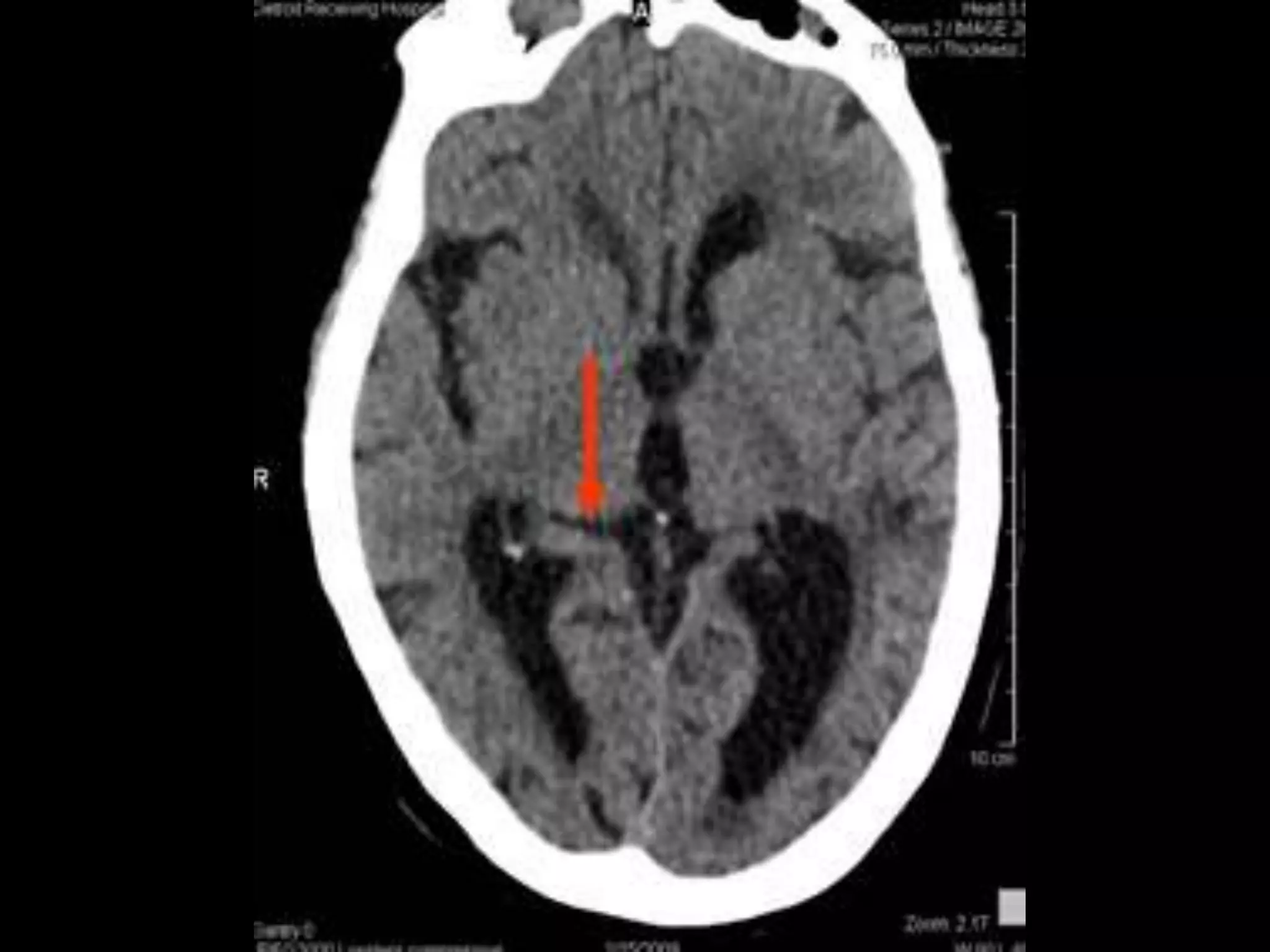 basal cisterns final.ppt