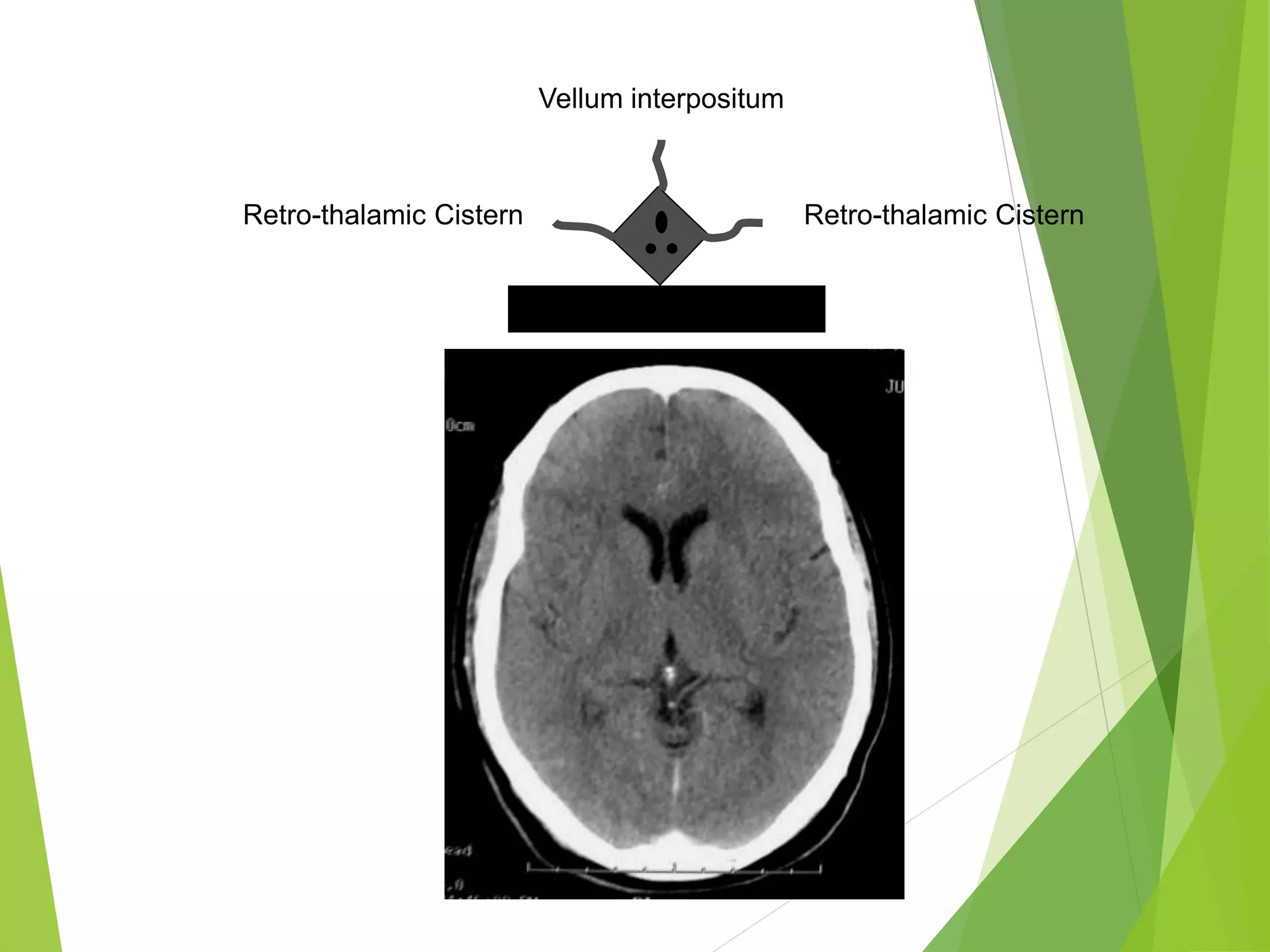 basal cisterns final.ppt