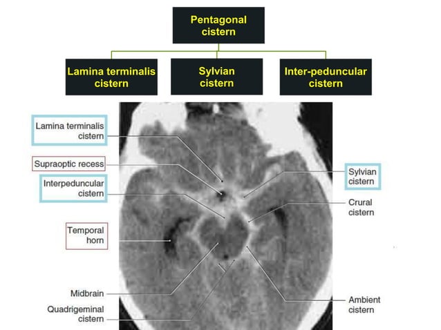 basal cisterns final.ppt