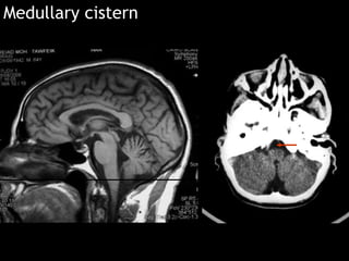 basal cisterns final.ppt