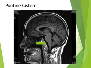 basal cisterns final.ppt