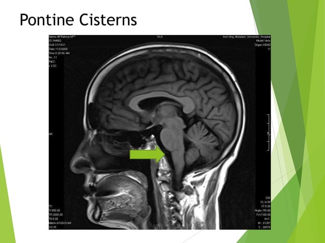 basal cisterns final.ppt