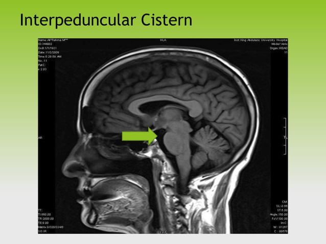 basal cisterns final.ppt
