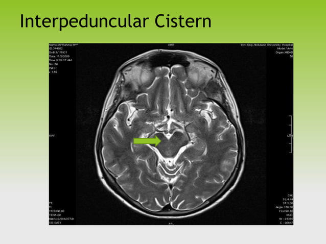 basal cisterns final.ppt