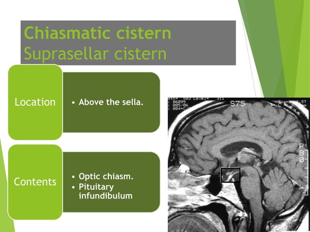 basal cisterns final.ppt