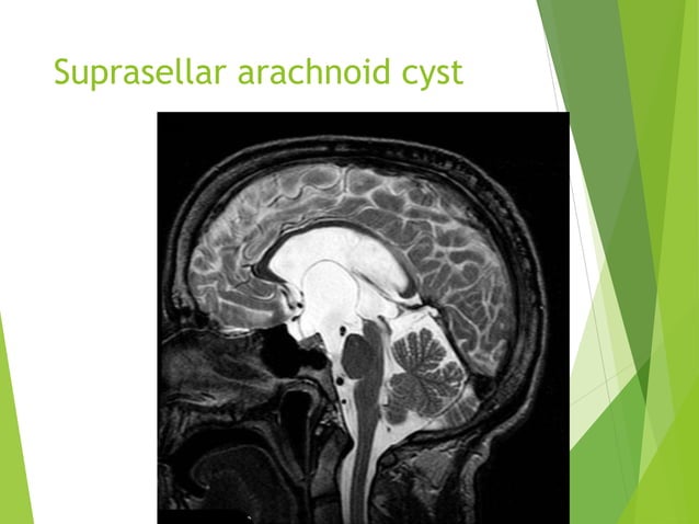 basal cisterns final.ppt