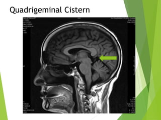basal cisterns final.ppt