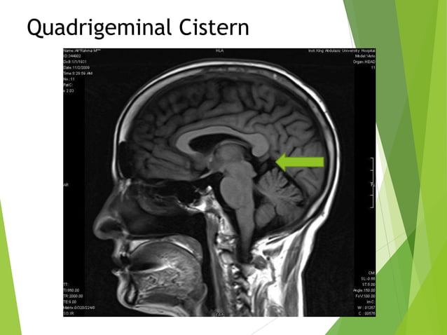 basal cisterns final.ppt
