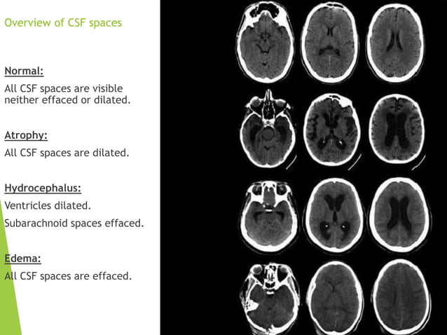 basal cisterns final.ppt