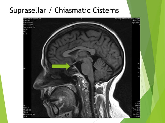 basal cisterns final.ppt