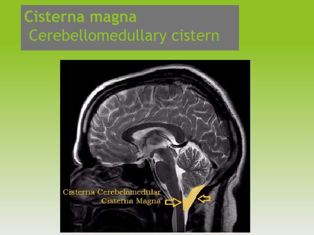 basal cisterns final.ppt
