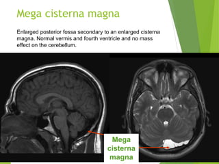 basal cisterns final.ppt