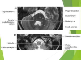 basal cisterns final.ppt