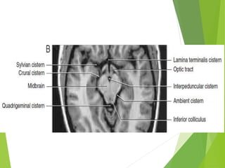 basal cisterns final.ppt