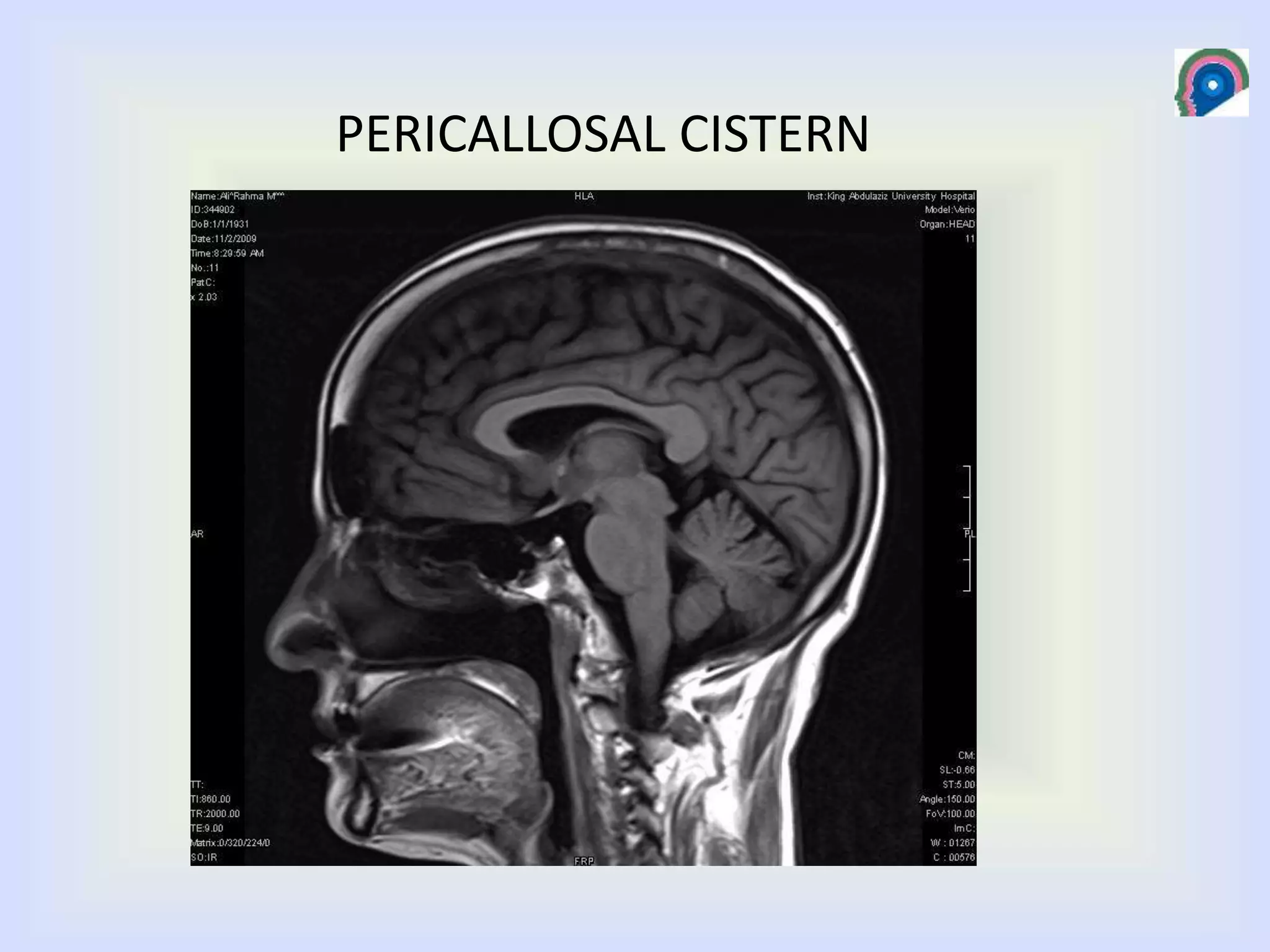 basalcisterns of brain | PDF