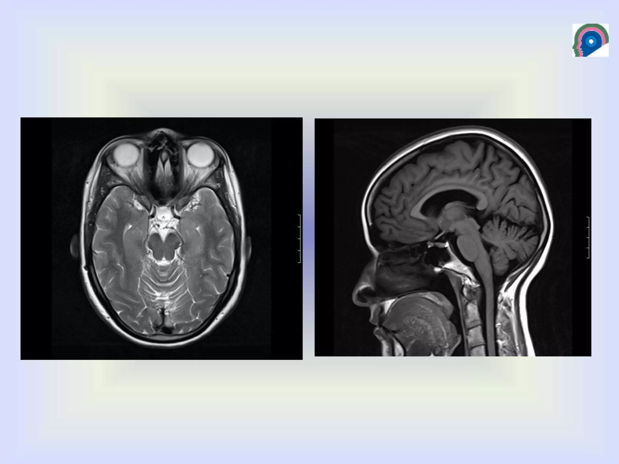 basalcisterns of brain | PDF