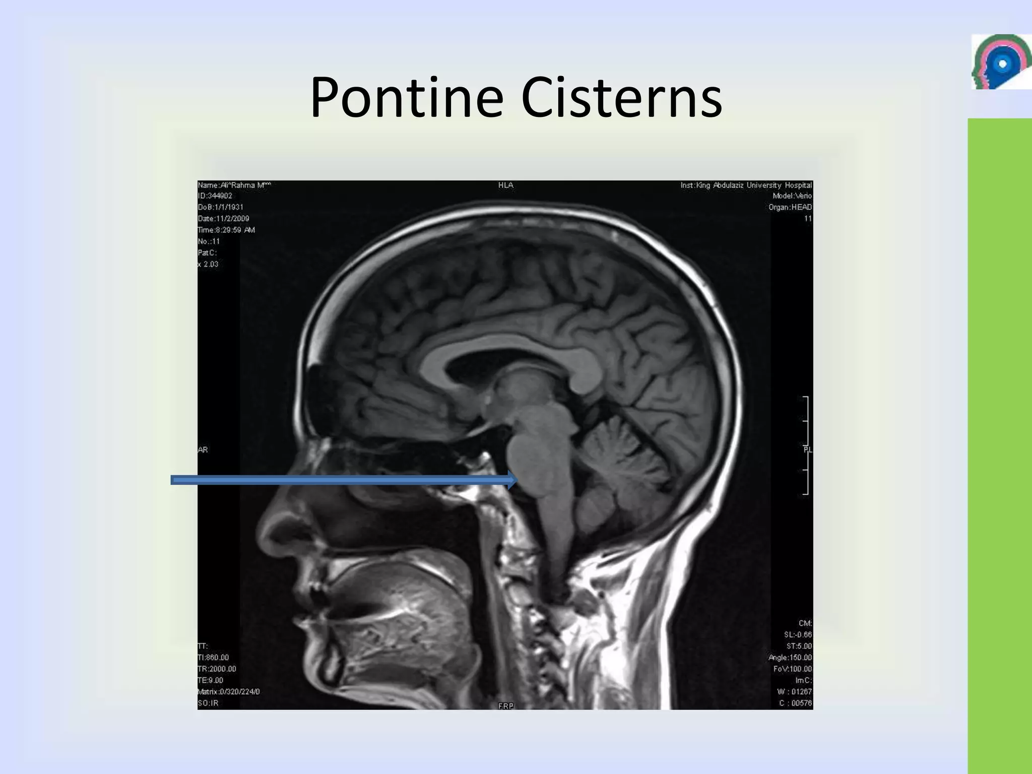 Cisterns of brain | PPTX