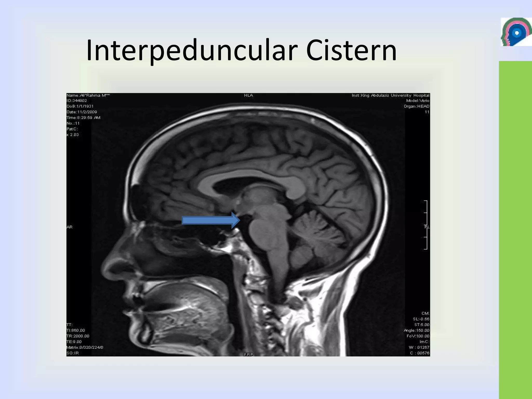 Cisterns of brain | PPTX