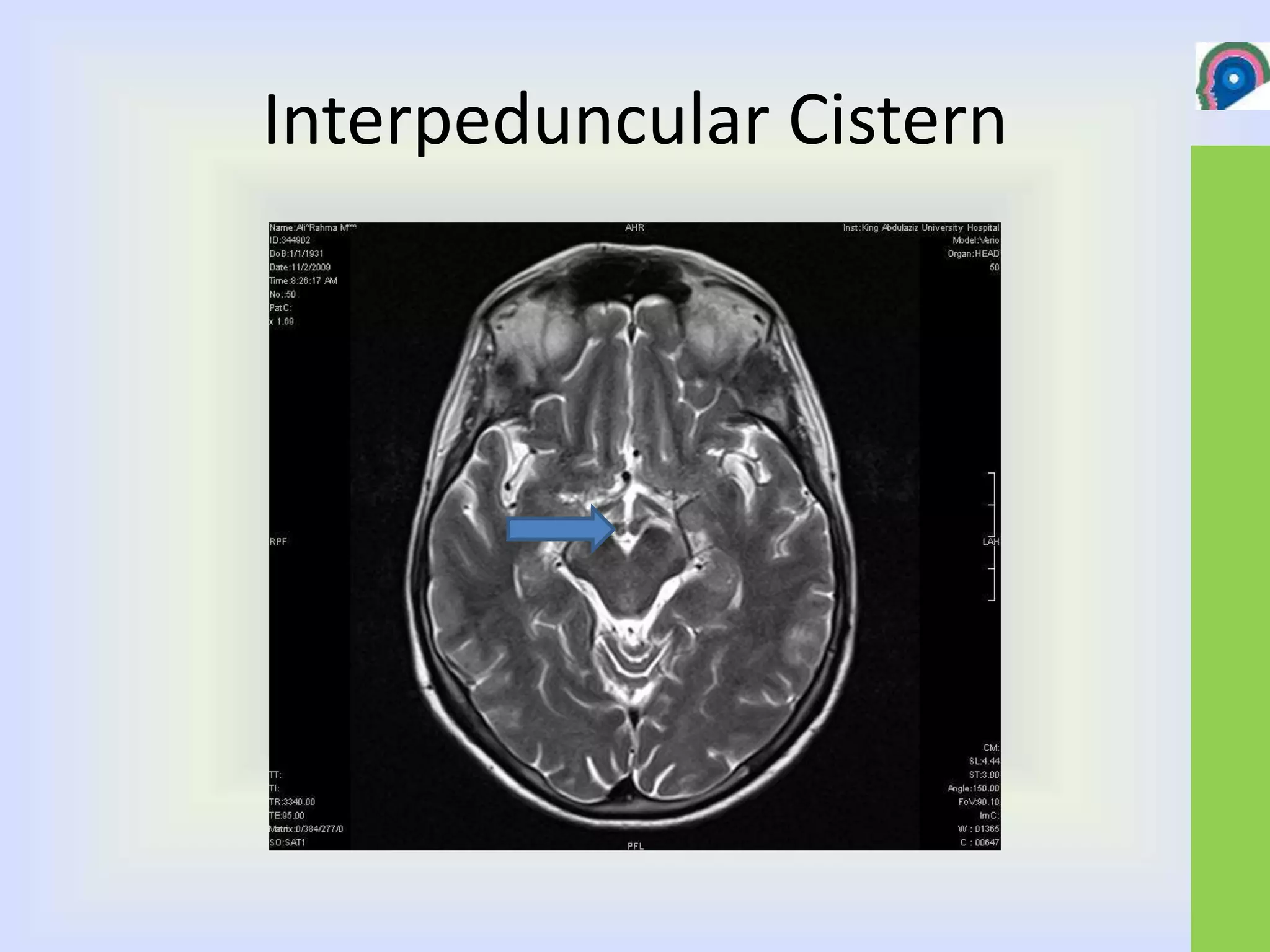Cisterns of brain | PPTX
