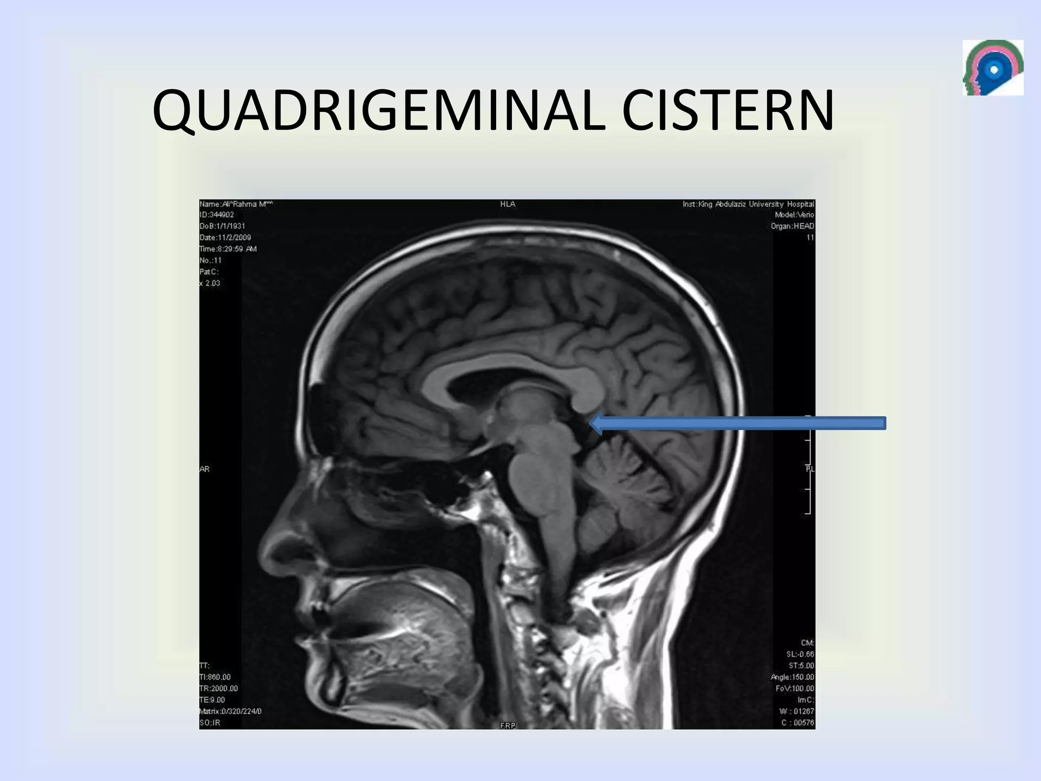Cisterns of brain | PPTX