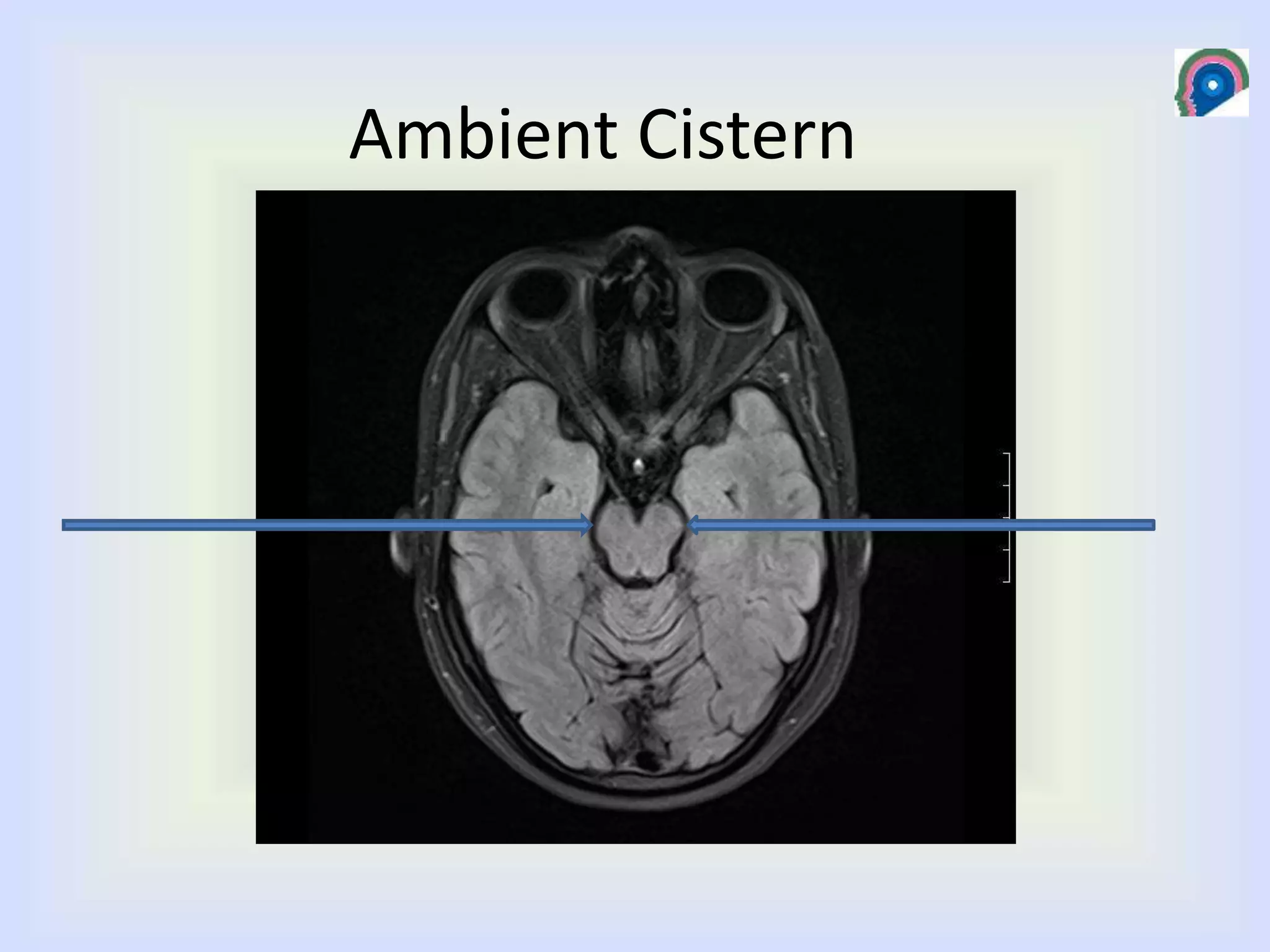 Cisterns of brain | PPTX