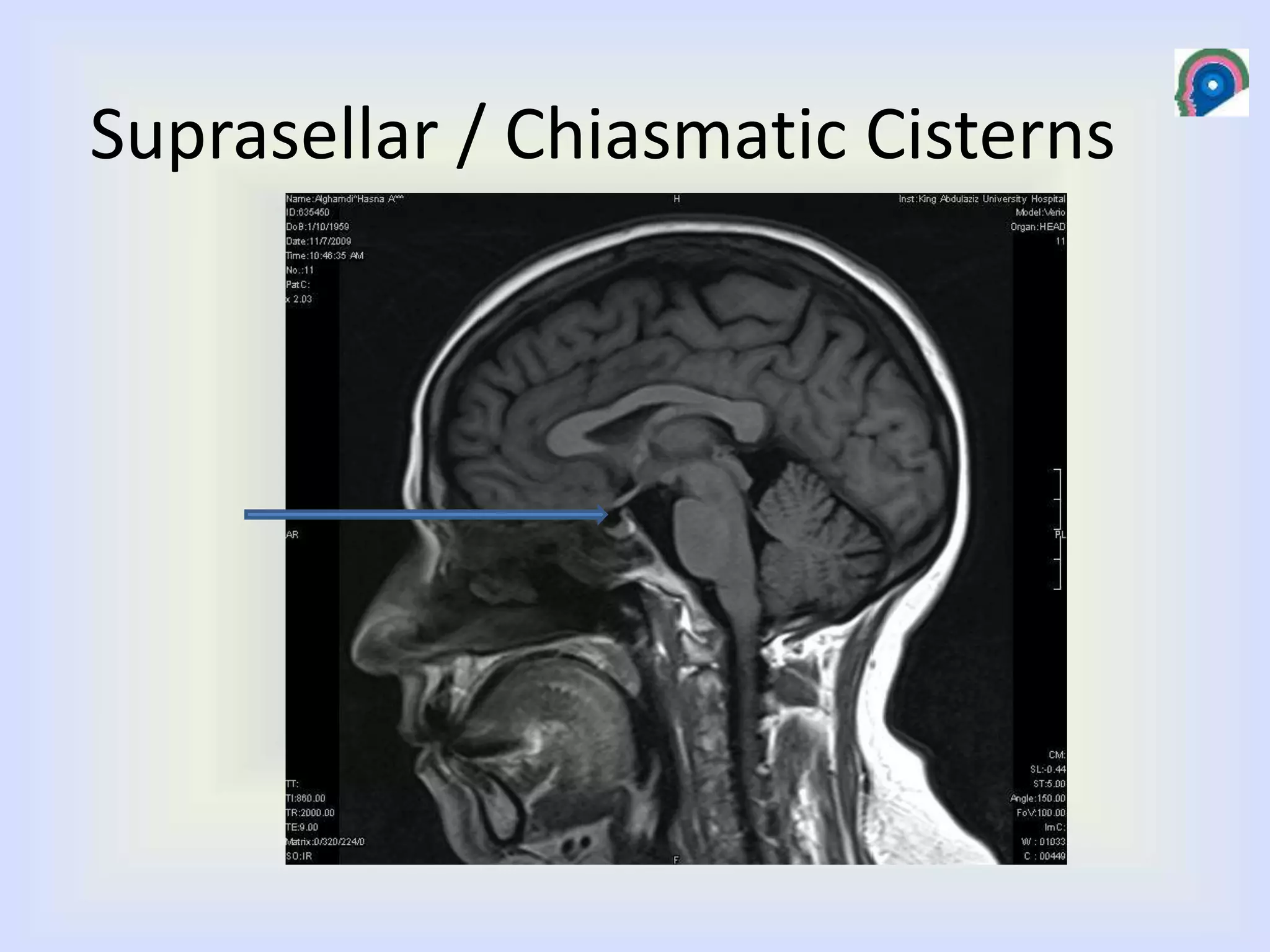 Cisterns of brain | PPTX