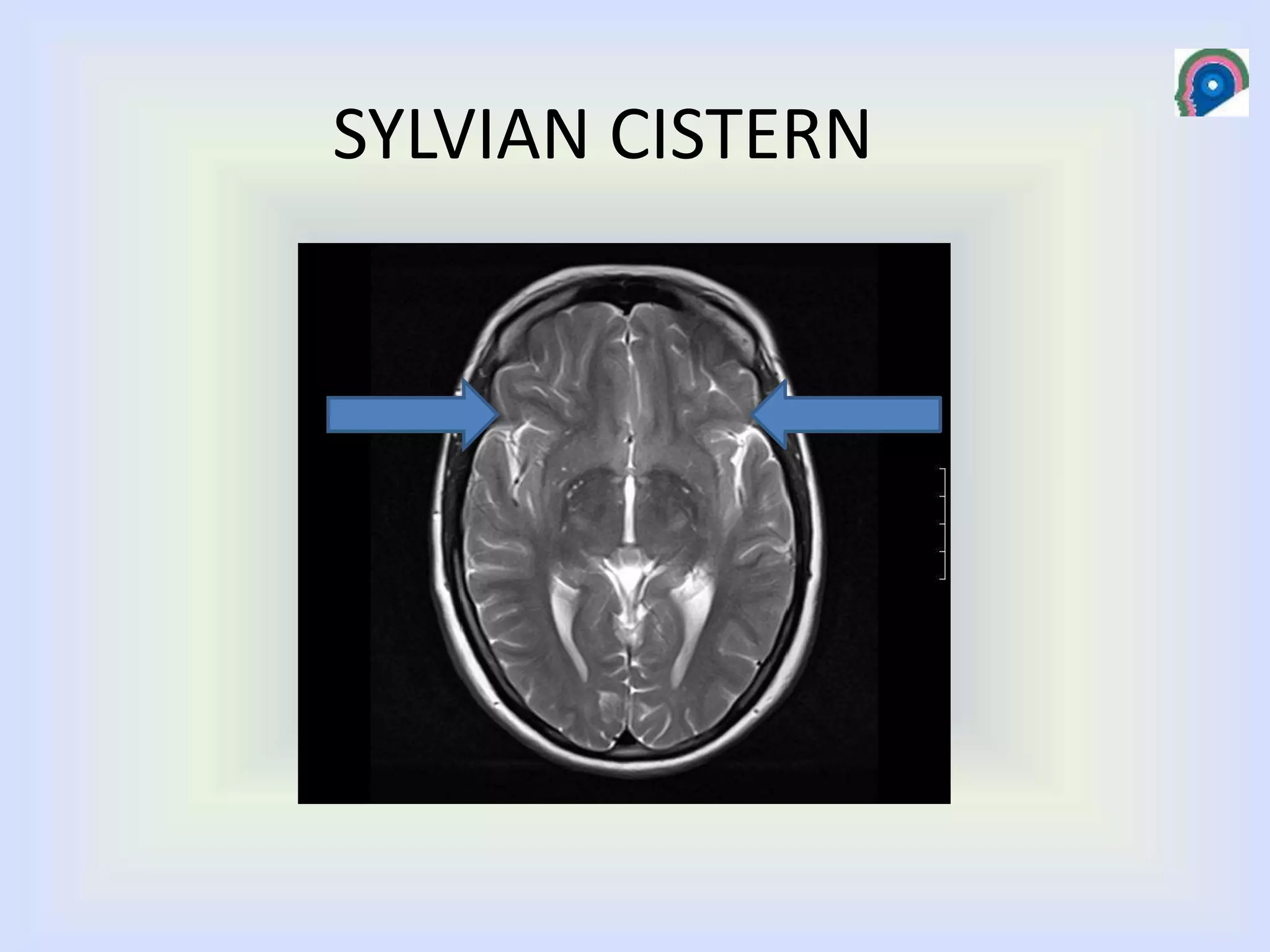 Cisterns of brain | PPTX