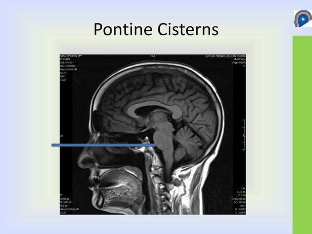 Cisterns of brain | PPTX | Brain and Nervous System Disorders ...