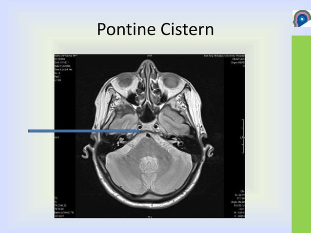 Cisterns of brain | PPTX | Brain and Nervous System Disorders ...
