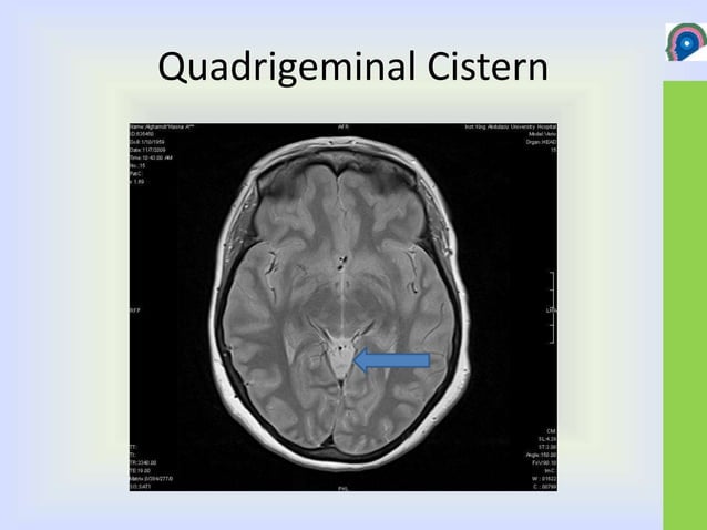 Cisterns of brain | PPTX | Brain and Nervous System Disorders ...