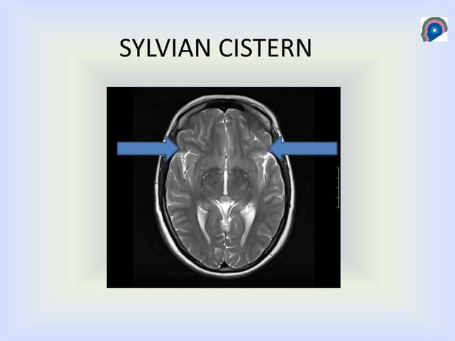 Cisterns of brain | PPTX | Brain and Nervous System Disorders ...