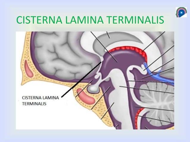 Cisterns of brain | PPTX | Brain and Nervous System Disorders ...