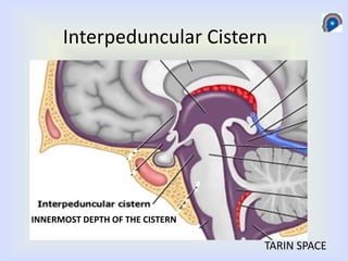Subarachnoid Cisterns