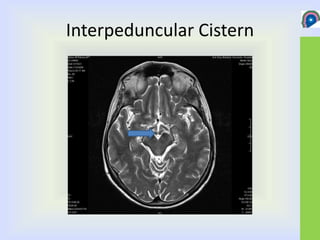 Interpeduncular Cistern