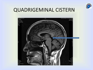 Basal Cisterns Anatomy