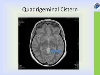 Quadrigeminal Cistern Anatomy