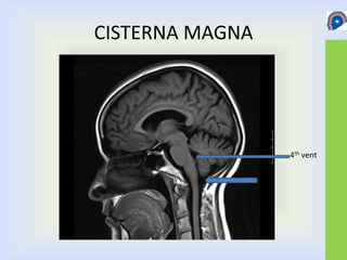 Cisterna Magna Anatomy