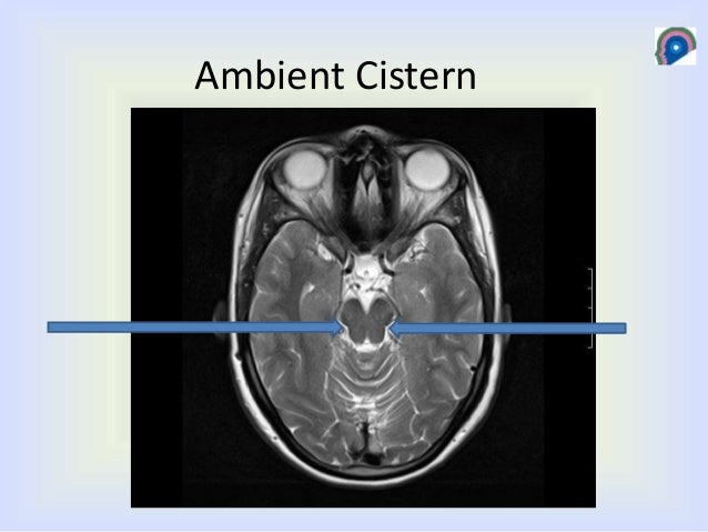 Cisterns of brain