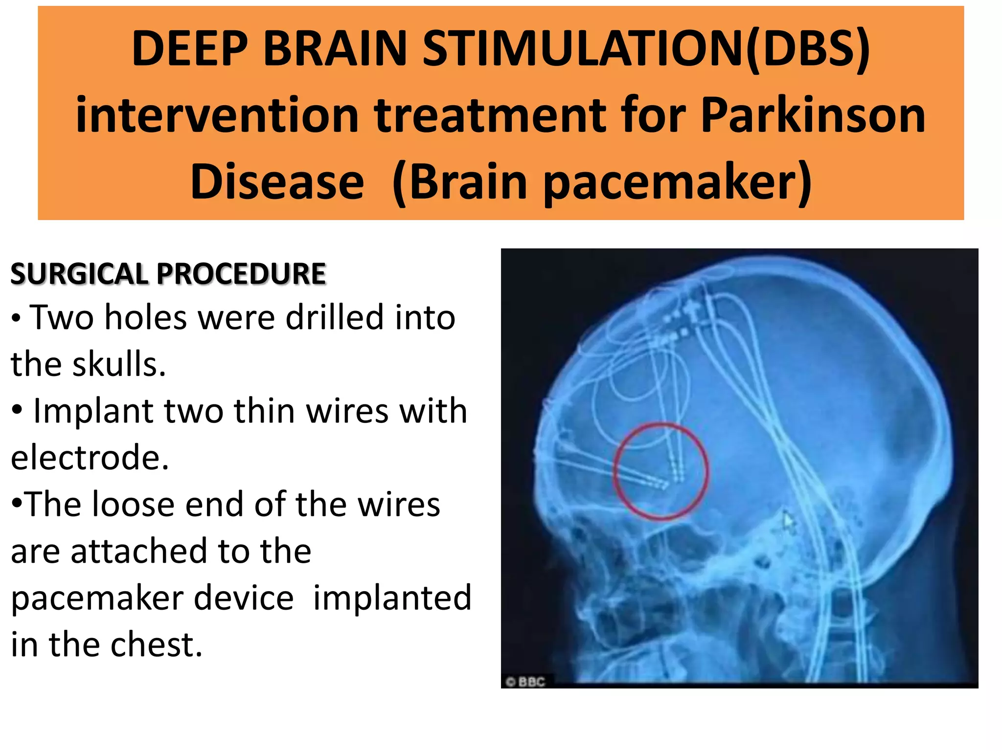 Basal ganalia :Motor function &Deep Brain stimulation (DBS) | PPTX ...