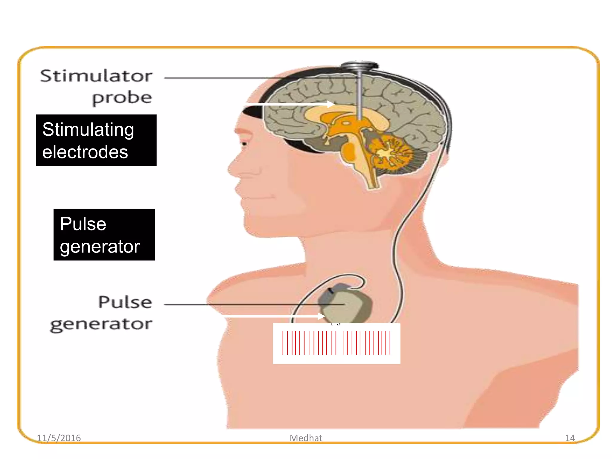 Basal ganalia :Motor function &Deep Brain stimulation (DBS) | PPTX ...