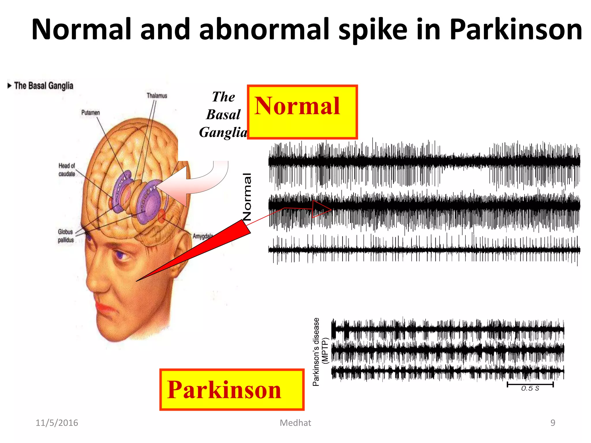 Basal ganalia :Motor function &Deep Brain stimulation (DBS) | PPTX ...