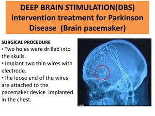 Basal ganalia :Motor function &Deep Brain stimulation (DBS) | PPTX ...