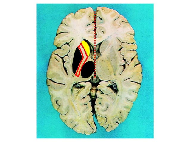 Anatomy of Basal ganglia | PPT