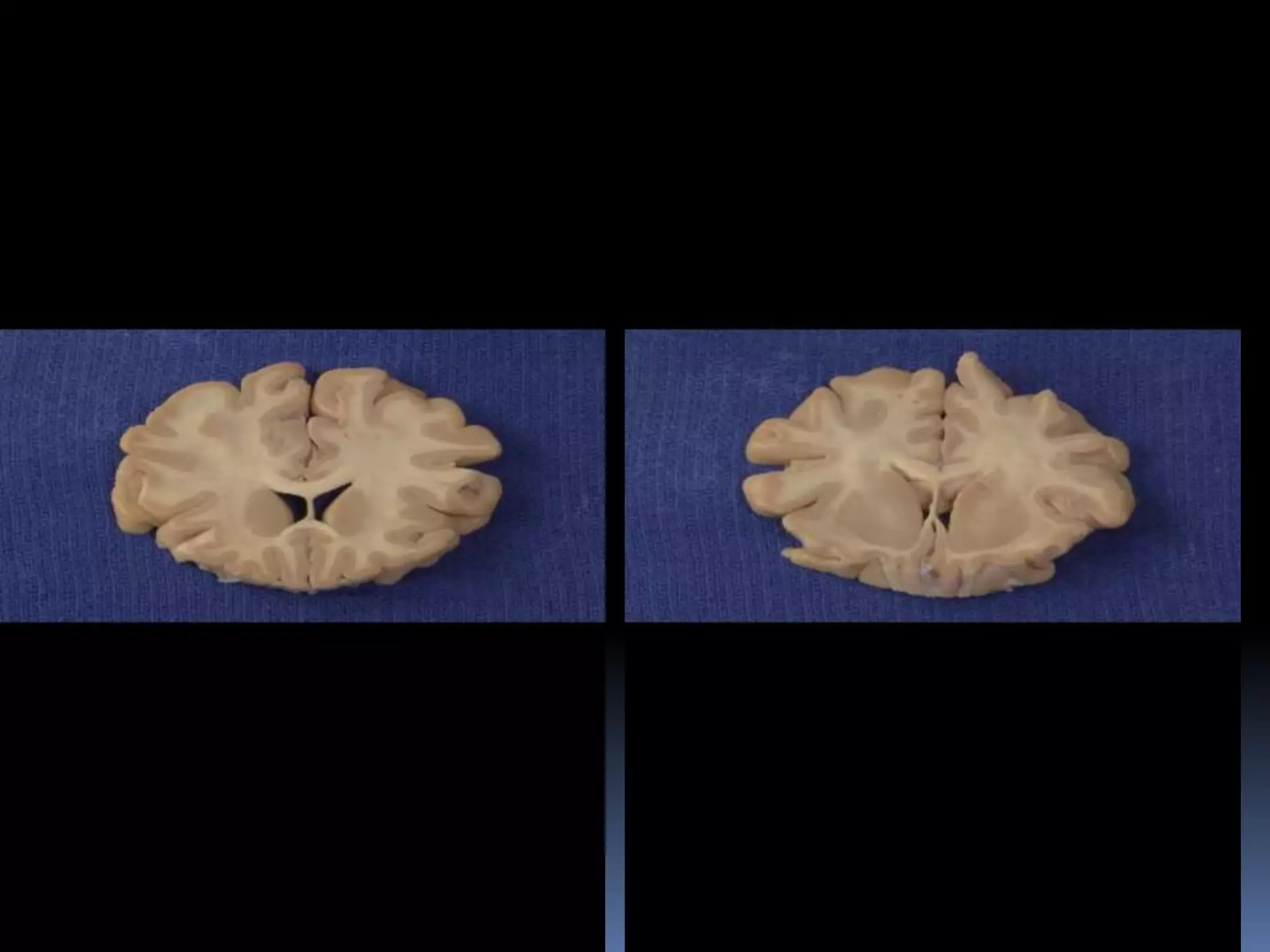 Basal ganglia by Dr.RAJESH PULIPAKA. | PPT