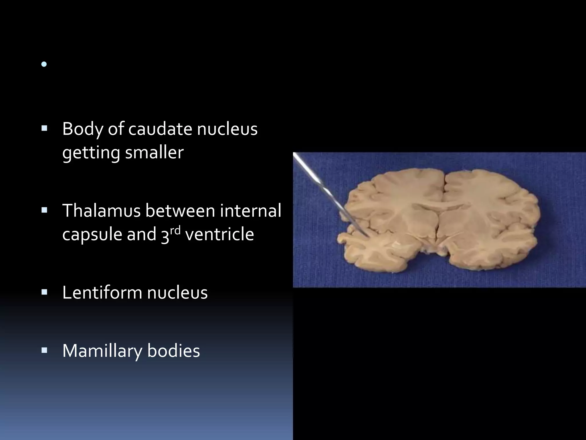 Basal ganglia by Dr.RAJESH PULIPAKA. | PPT