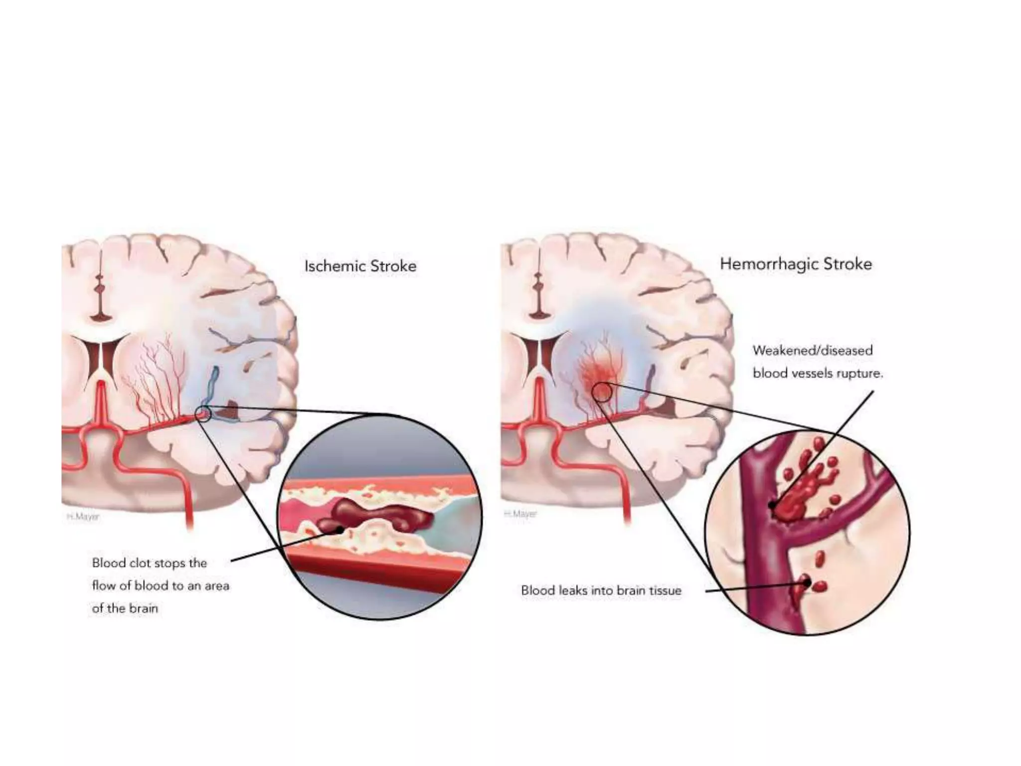 Basal ganglia stroke | PPTX