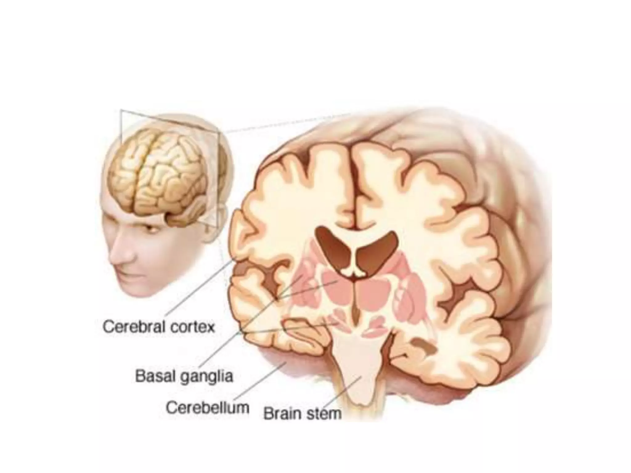 Basal Ganglia Stroke Ppt