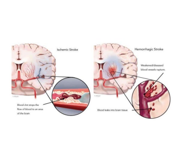Basal ganglia stroke