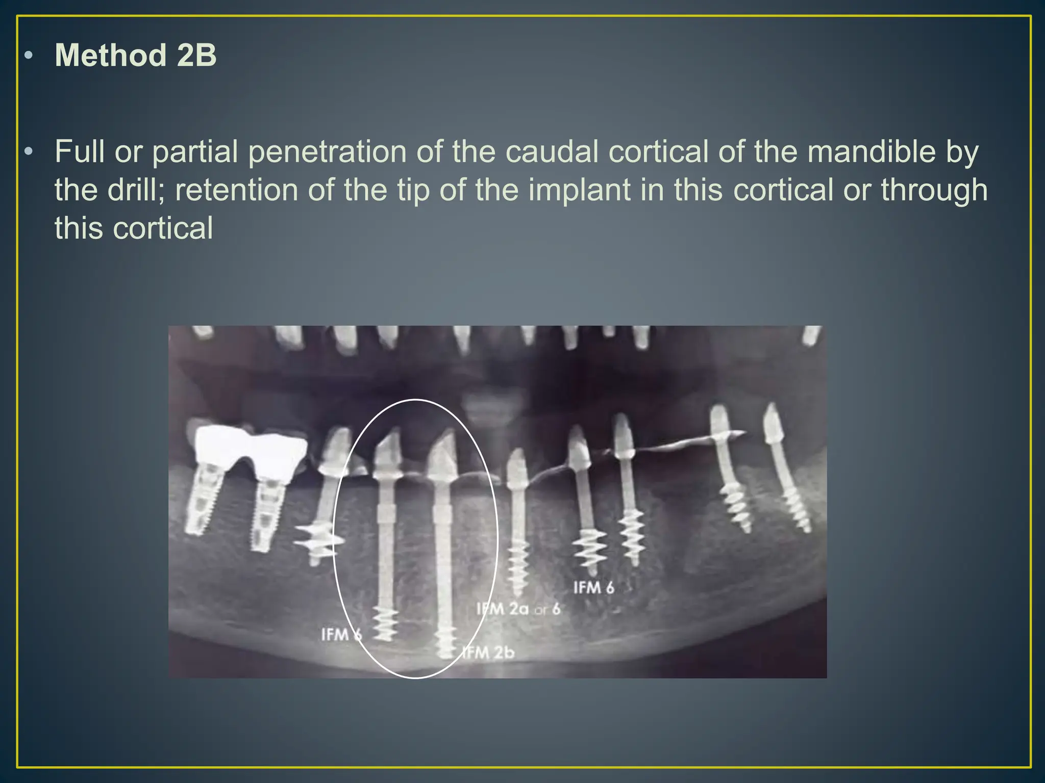 Basal Implant rehabilitation in oral surgery | PPTX