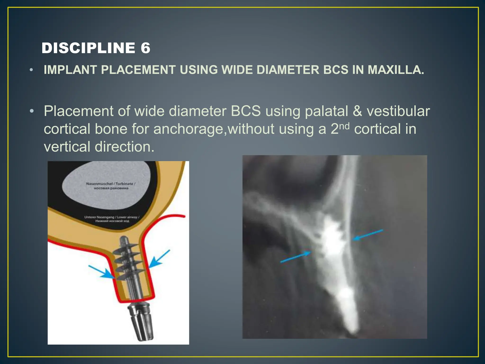 Basal Implant rehabilitation in oral surgery | PPTX